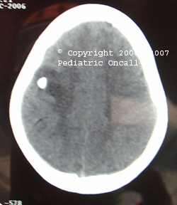 Calcified Granuloma | Spot Diagnosis | Pediatric Oncall
